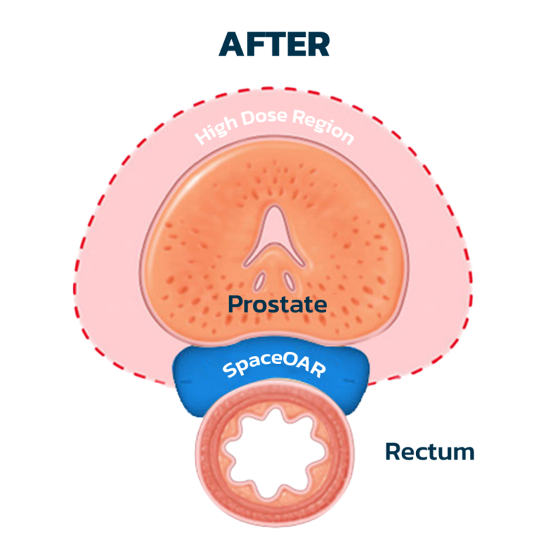 Boston Scientific SpaceOAR™ Hydrogel - menMD