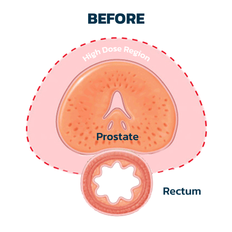 Boston Scientific SpaceOAR™ Hydrogel - menMD